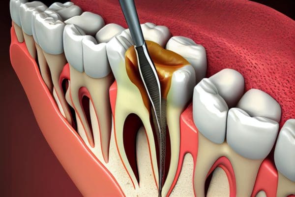 Root Canal Therapy Newport | Save Your Tooth | Kensington Court
